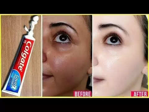 Beauty Hack Alert: How to Use Toothpaste for Pimples and Say Goodbye to ...